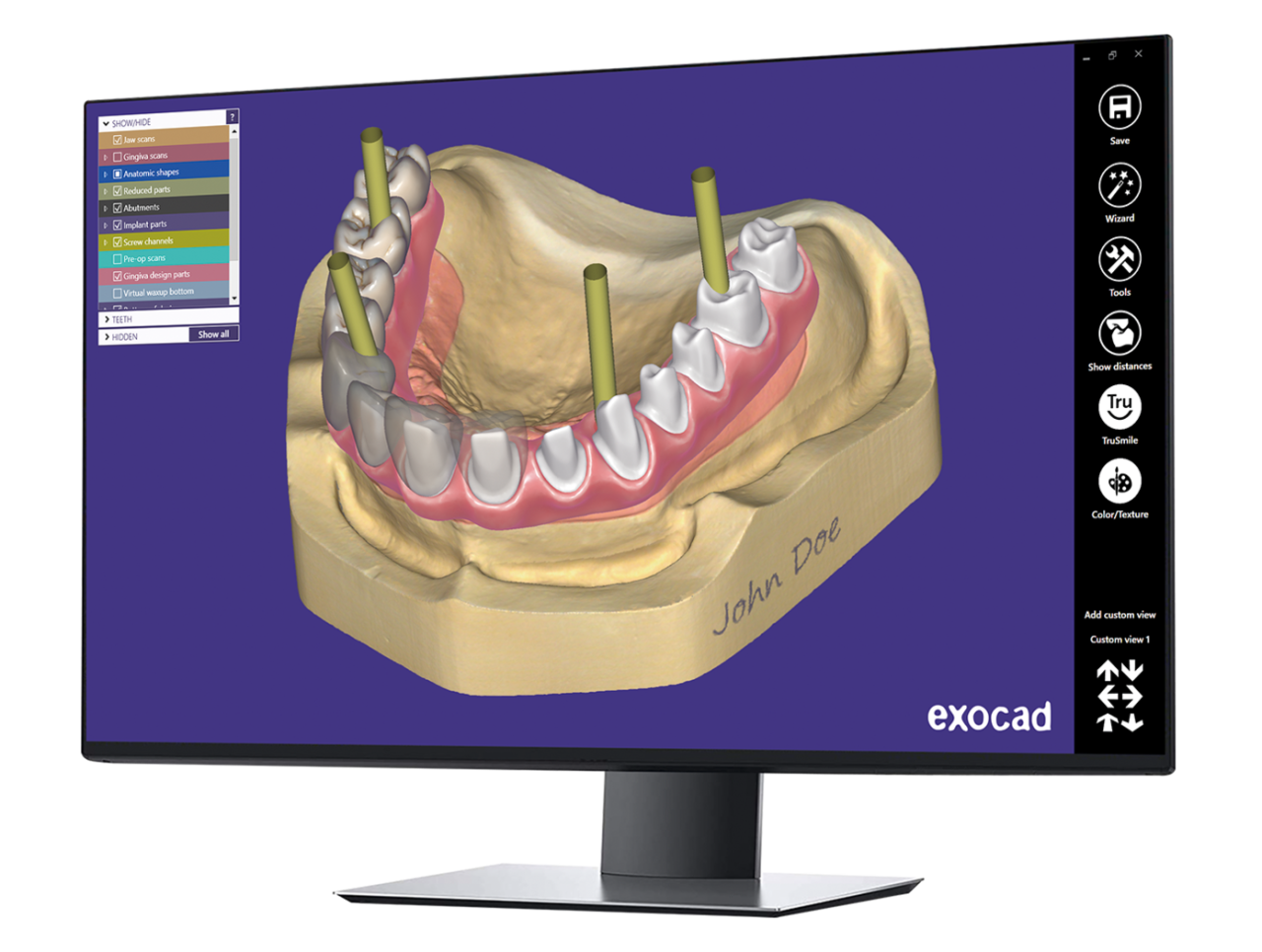 ExoCAD (Digital Dentistry) | 3DD Digital Fabrication เครื่องพิมพ์3มิติ ...